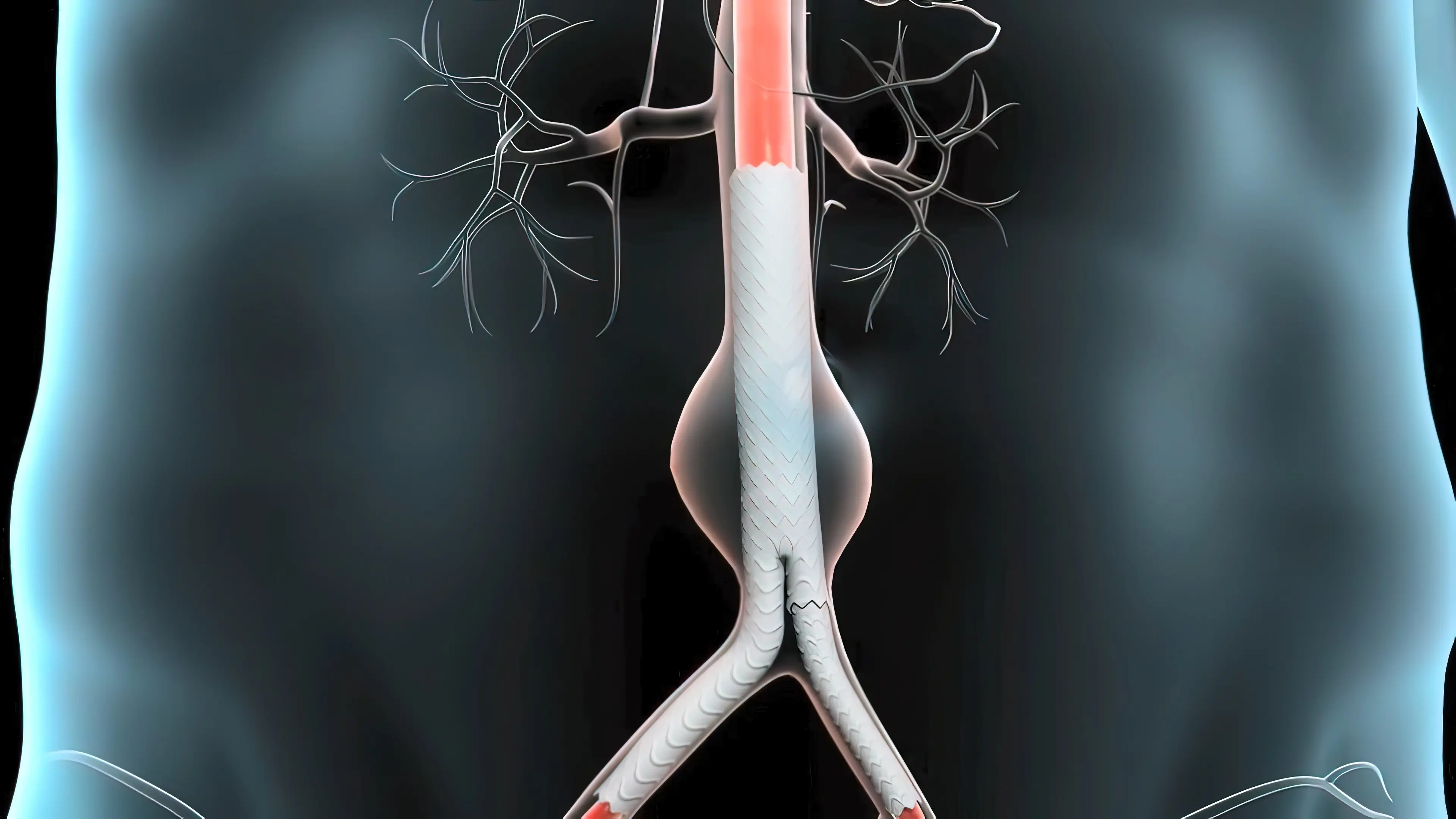 Endovascular Aortic Aneurysm Repair (EVAR, TEVAR)